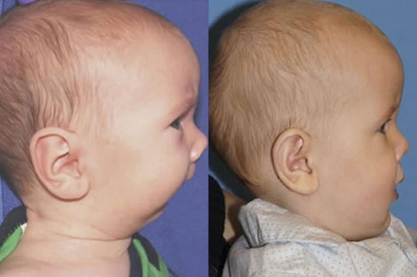 Hội chứng Pierre Robin - NOVAGEN