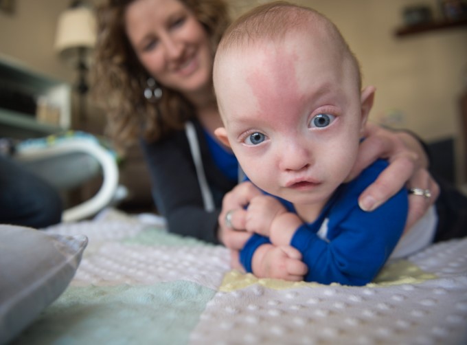 Hội chứng Cri Du Chat - NOVAGEN